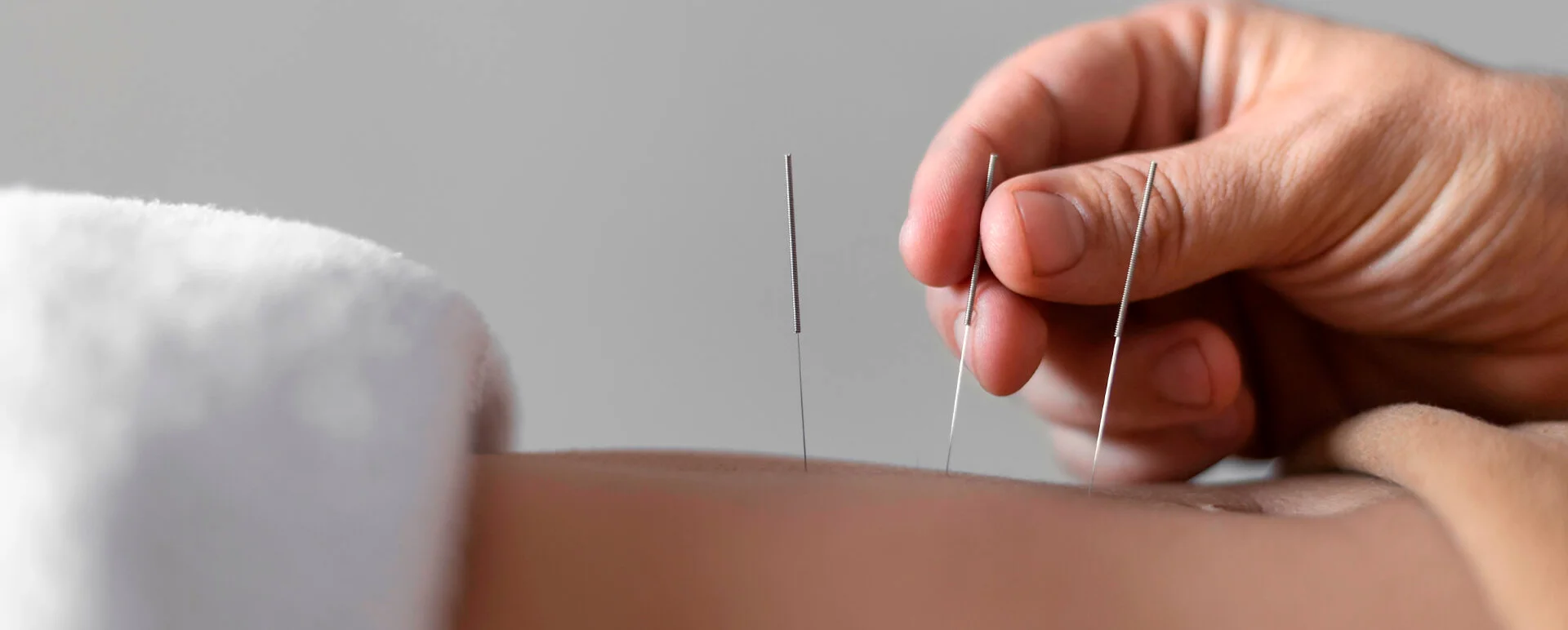 Acupuncture | IDCC Health Services in Brooklyn